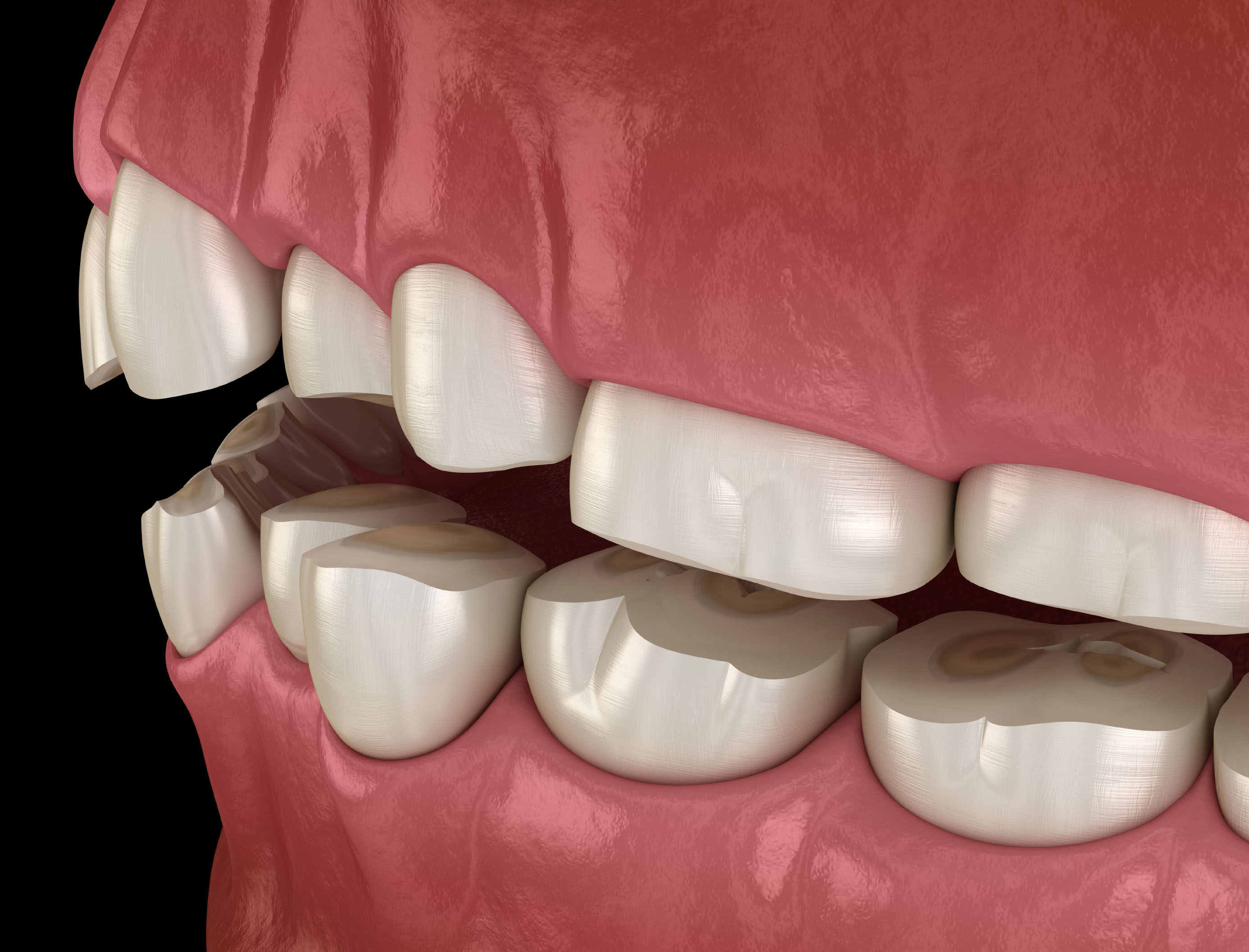 Wear and Erosion | Smith and Van Lierop Dentistry
